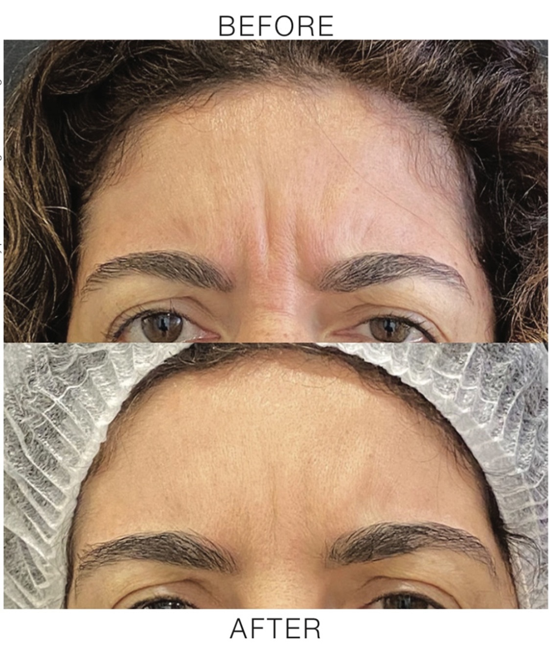 The Truth About Salmon DNA Microneedling: Does It Really Work?